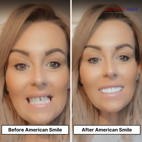 Veneers - Instant Smile Veneer for a Perfect Smile – American Smile USA